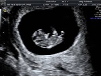 Dating Pregnancy Ultrasound Scan | Sonography | USG Test | Best & top ...