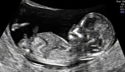 Nuchal Translucency Scan | NT / NB Ultrasound | Sonography USG Test ...